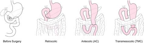 Impact Of Antecolic Vs Transmesocolic Reconstruction On Delayed Gastric Emptying Following