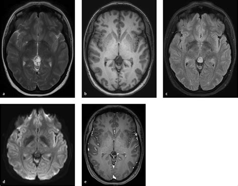 11 Simple Pineal Cyst Radiology Key