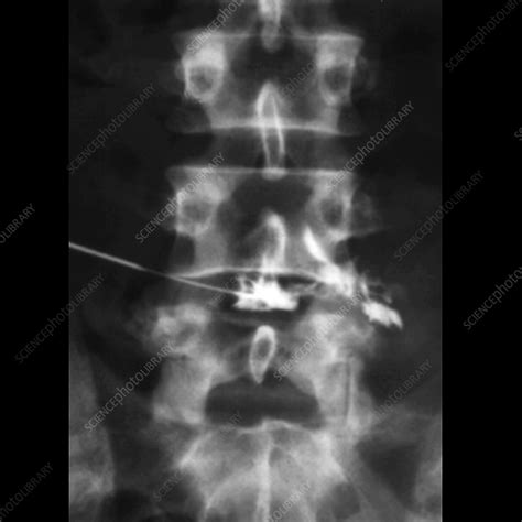 Disc Herniation X Ray