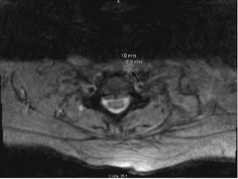 MRI Cervical Spine MRI Image Showing Abnormal Signal With Prevertebral Download Scientific