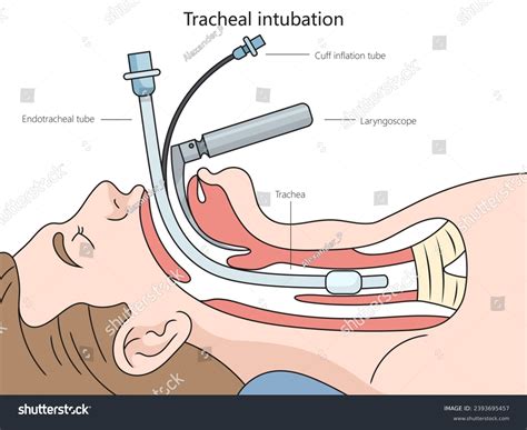 Tracheal Intubation Structure Diagram Hand Drawn Stock Illustration 2393695457 Shutterstock