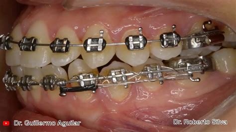 Retracción En Ortodoncia: Un Proceso Clave Para Una Sonrisa Perfecta | Ortodoncia Junin