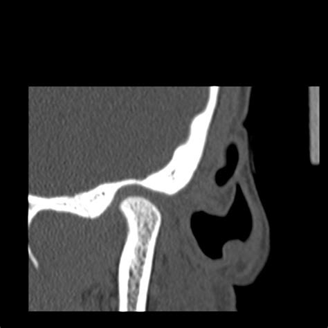 Normal Temporal Bone Ct With Annotated Images Radiopaedia 84293 99584