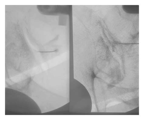 Fco View With Needle Entering From Medial To Lateral Along Mid Body Of