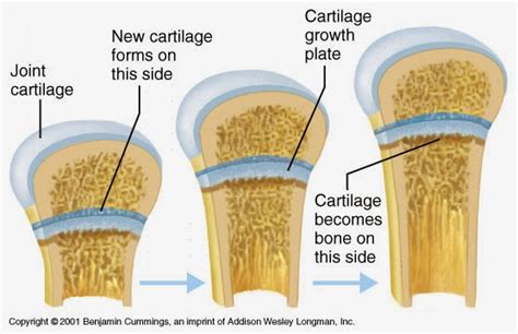 Treating Achondroplasia Treating Achondroplasia The History Of The