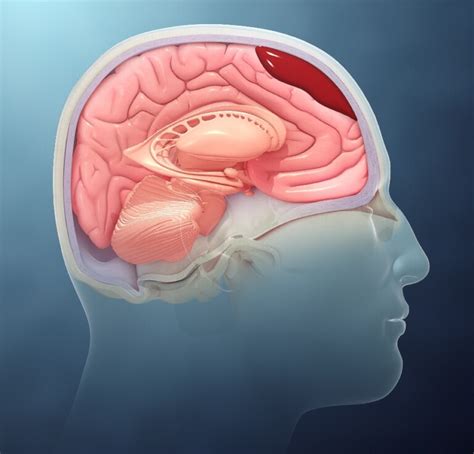 Chronic Subdural Hematoma Symptoms Young Vs Old Patients Scary Symptoms