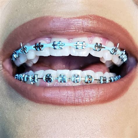 Adult Braces At 24 On Instagram “guess Who Got A Power Chain 🔸️🔸️🔸