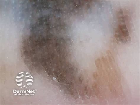 Dermoscopy Pattern Analysis