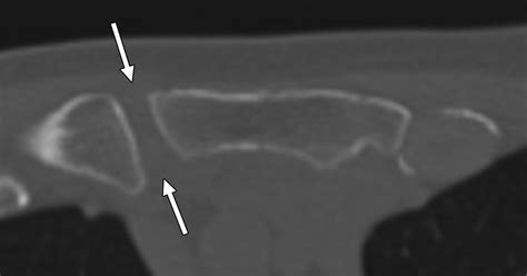 Sternoclavicular Joint Calcification Radiology At Hayden Atkin Blog
