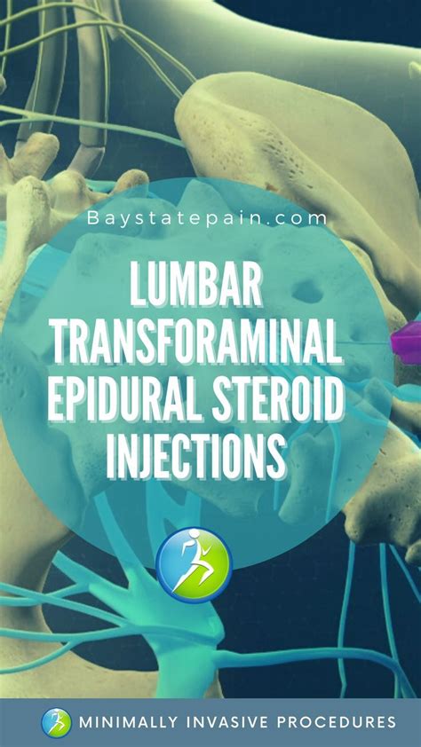 Epidural Steroid Injection Artofit