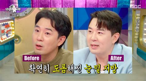 붐 눈밑 지방 재배치 고백 코 수술 20년 됐다재수술큰 도전 라스 Oh쎈 리뷰 네이트 연예