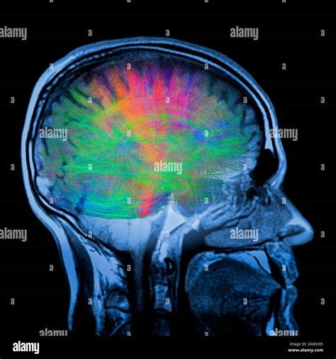 Computer Artwork Of A Mri Top View Of The Brain Showing White Matter