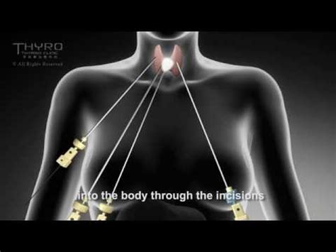 Minimally Invasive Thyroidectomy Thyroid Thyroid Cancer Goiter Hyperthyroidism YouTube