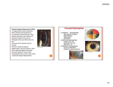 Cornea Stricture And Disorders In The Eye Ppt