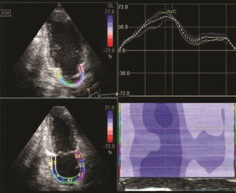 Assessment Of Peak Systolic Longitudinal Left Atrial Strain Las By 2d