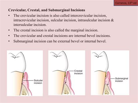 General Principles Of Periodontal Surgery Pptx