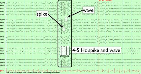 Idiopathic Generalized Epilepsy