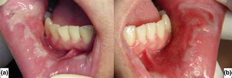 Syphilis Mouth Early