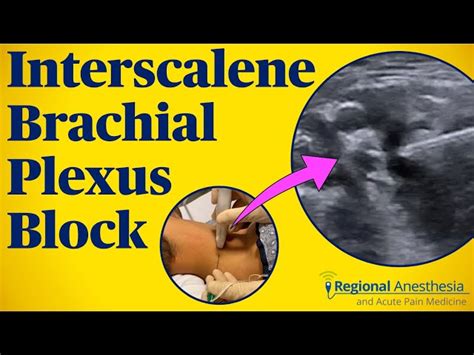 Interscalene Block
