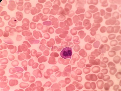 Eritroblasto Displásico Análisis De Sangre Glóbulos Rojos Foto de archivo Imagen de aspire