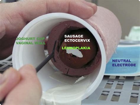 A Novel Training Model For The Loop Electrosurgical Excision Procedure American Journal Of