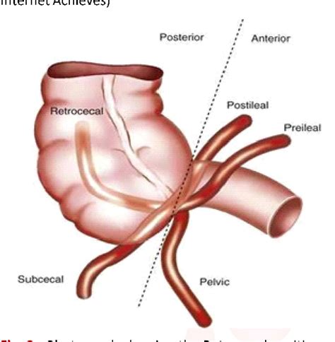 The Appendix Retrocecal Arterial Supply Appendicitis 55 Off