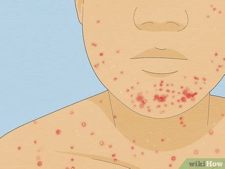 How To Tell If Your Acne Is Hormonal Or Bacterial