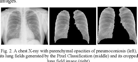 Figure 2 From Automated Pneumoconiosis Detection On Chest X Rays Using