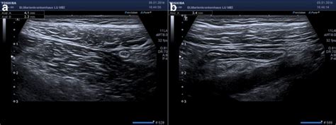 Classification Of Acute Appendicitis Caa Type 0 On Us Normal Download Scientific Diagram