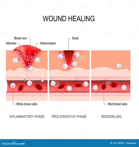 Wound Healing Process Tissue Injury And Inflammation Stock Vector