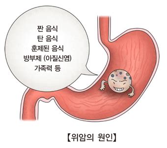 진행성 위암 질환백과 의료정보 건강정보 서울아산병원