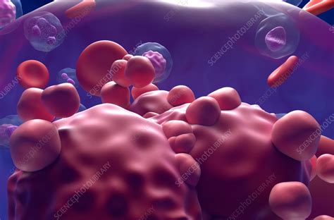 Acute Lymphoblastic Leukemia Illustration Stock Image F0385779 Science Photo Library