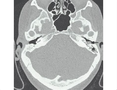 CT Temporal Bone Showing An Area Of Soft Tissue Opacification At The Download Scientific