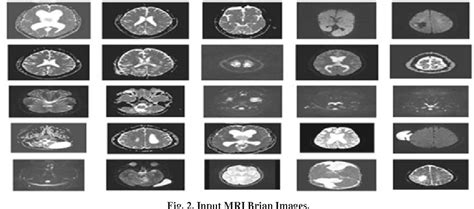 figure 2 from analysing mri brain images using fuzzy analysing mri