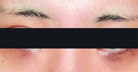 아이 눈 밑 다크서클 알레르기비염 때문일 수도