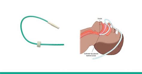 Main Uses Of Nasal Catheter Nasal Cannula Vs Nasal Catheter