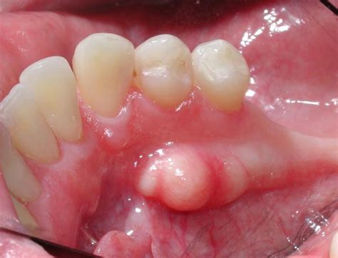 What Are Mandibular Tori Insights On Causes Symptoms And Management