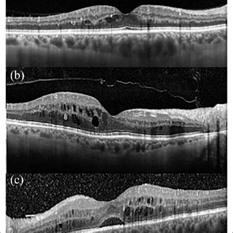 Pdf An Optical Coherence Tomography Based Grading Of Diabetic Maculopathy Proposed By An