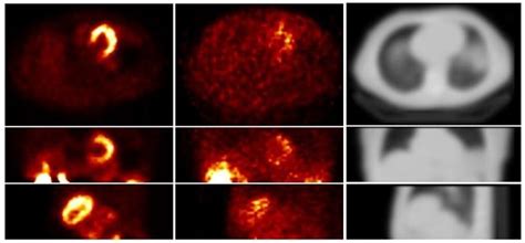 Deep Learning Improves Cardiac Images From Spect Only Scanners