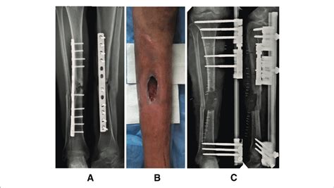 A 42 Year Old Man Who Suffered Chronic Osteomyelitis In His Right Download Scientific Diagram