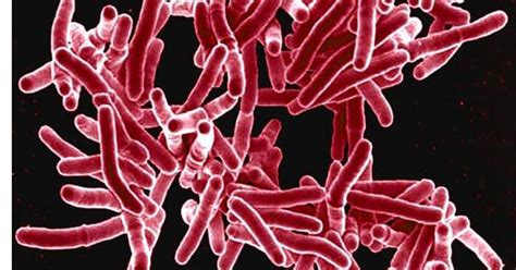 Health Dept Looking At Using Ai To Accelerate Screening And Diagnosis Of Tb Silicosis