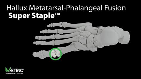Hallux Metatarsal Phalangeal Fusion Video Mpj Super Staple™ Youtube