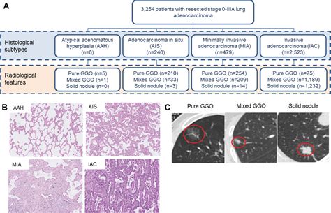 Lung Adenocarcinoma Histology