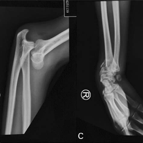 Pre Operative Radiographs Show A Divergent Dislocation Of The Elbow Download Scientific Diagram