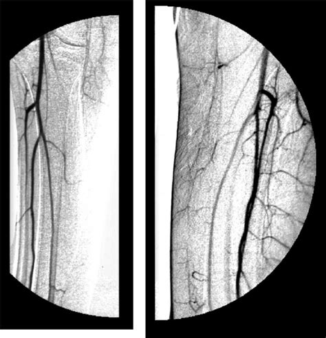 The Popliteal And Proximal Tibial Arteries Are Smooth And Uninvolved Download Scientific