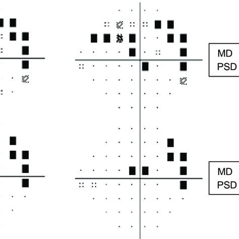 Changes In Visual Field Parameters Improvement In The Mean Deviation Download Scientific