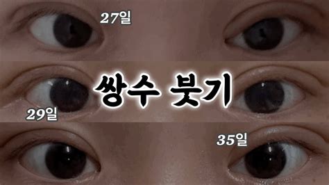 쌍수 후기 2 쌍수 브이로그쌍수 후기쌍수 한 달 차 후기쌍수 브이로그쌍수 붓기 빠지는 과정쌍수 매몰쌍커풀 수술쌍수 붓기쌍수 4주차붓기 빠지는 과정