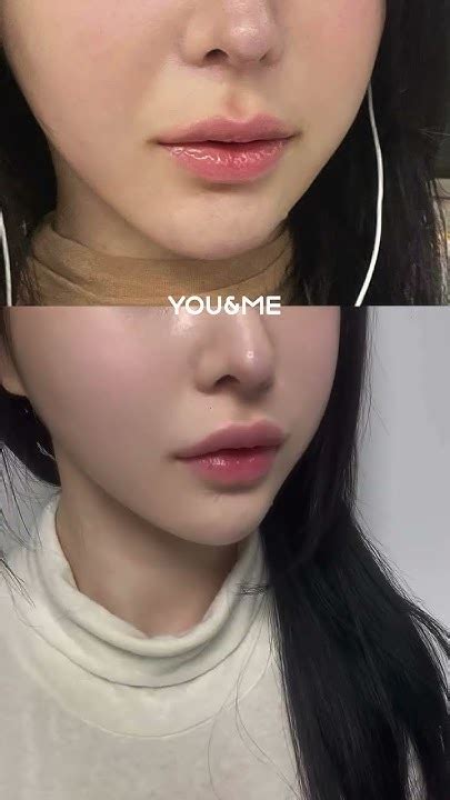 입술필러 맞으면 인중이 길어진다고 인중축소시술은 달라 Youtube