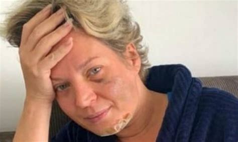 Polícia Civil Do Df Descarta Agressão E Diz Que Joice Hasselmann Sofreu