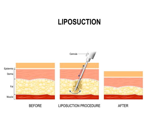 What Is Liposuction Manchester Private Hospital